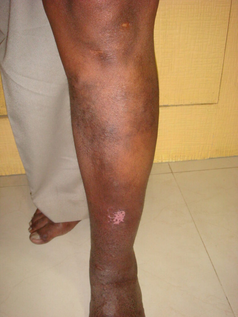 What is Vascular Disease - Vascular society of India