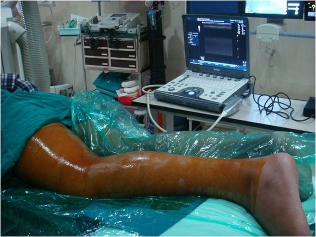 What is Vascular Disease - Vascular society of India